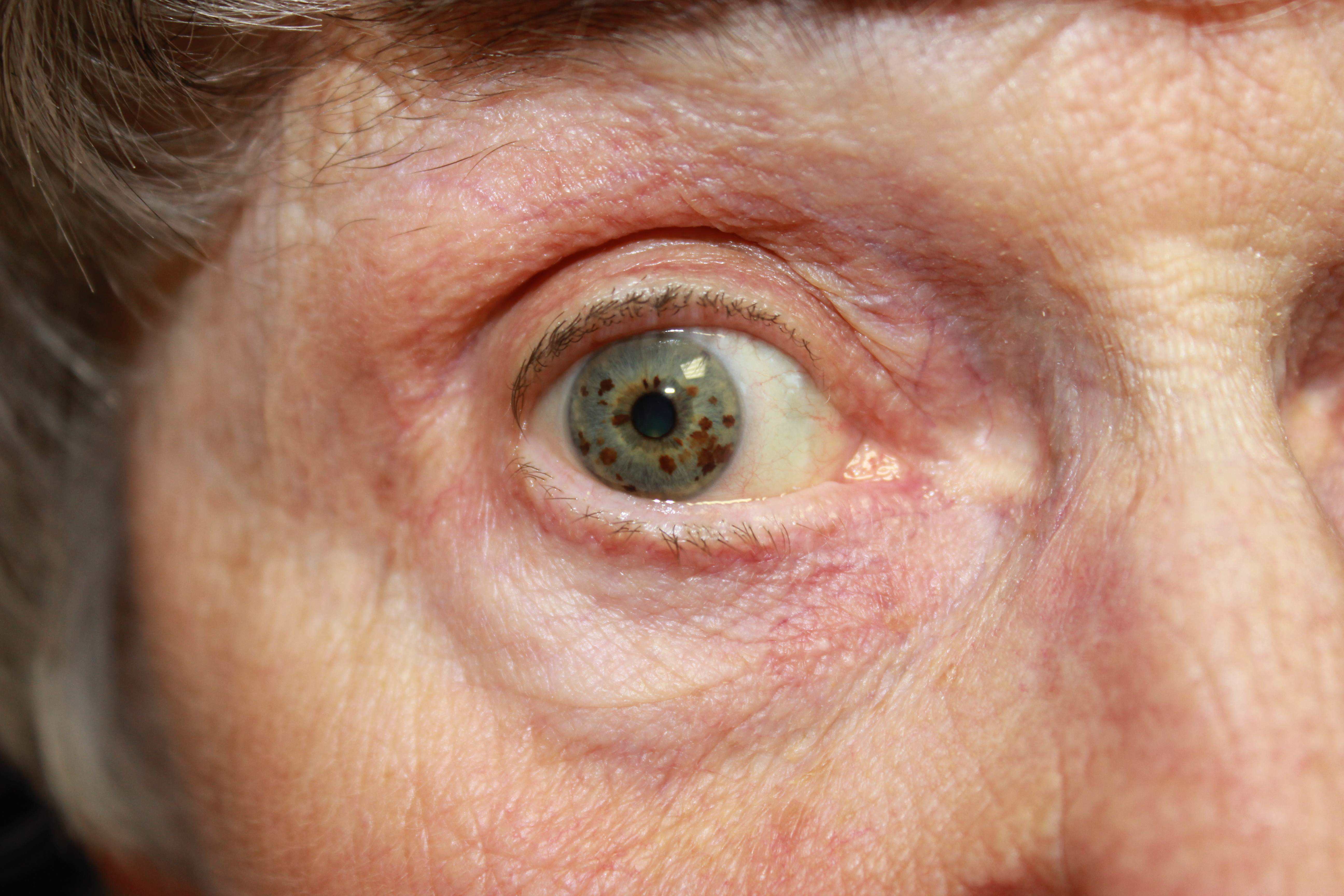 Dry Eyes Computer Vision Syndrome Eyelid Hygiene Dry Eyes Computer Vision Syndrome Eyelid Hygiene